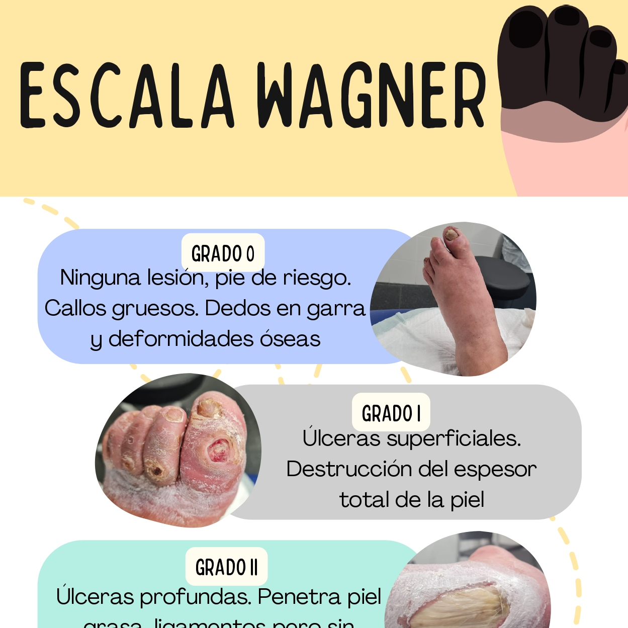 Escala de Wagner Va de ferides